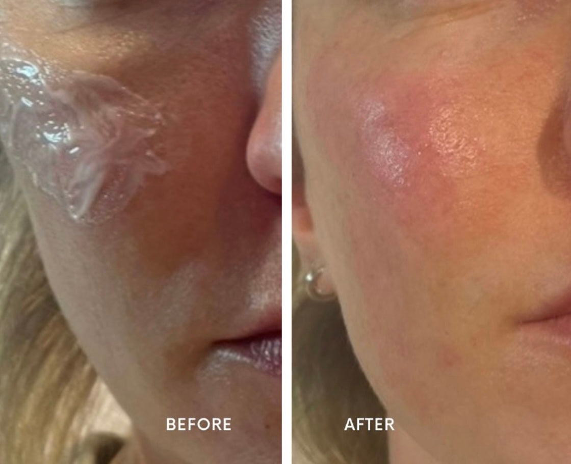 Cheek Filler Gosforth Newcastle Upon Tyne – Beauty At Gosforth Park